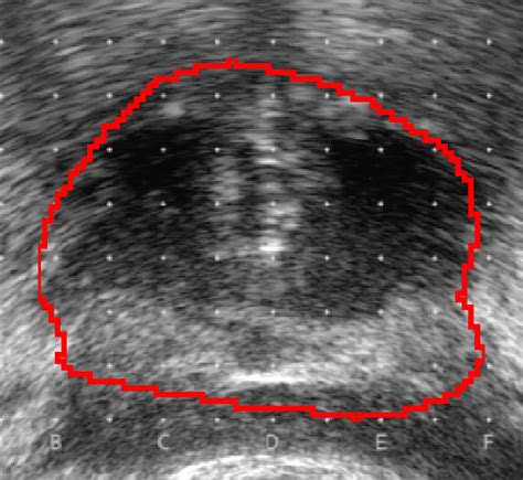 Limitations Of Trus Prostate Volume Segmentation A General Overview Download Scientific