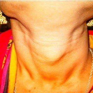 Multinodular MNG Goiter Download Scientific Diagram
