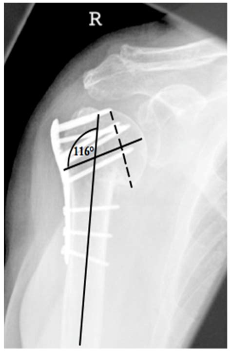Jcm Free Full Text It Is Always The Same—a Complication