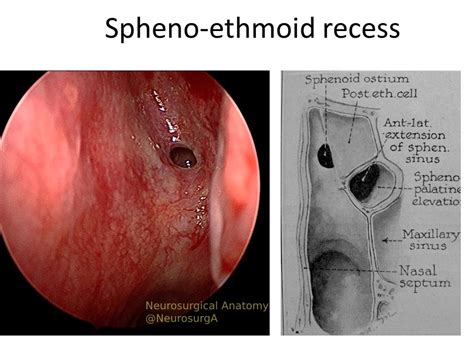 Sphenoethmoidal Recess