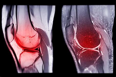 Arthroscopic Acl Repair Orlando Orthopaedic Center