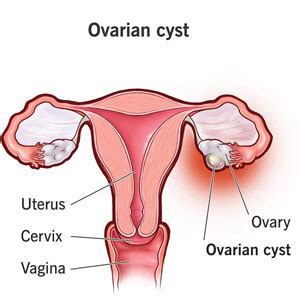 Ovarian Cyst Surgery Hospital In Jalandhar Akshar Hospital