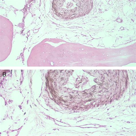 Lateral View Plain Radiograph Defines Diffuse Sclerosis Of Navicular Download Scientific
