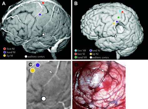 A Preoperative 3 D Surface Rendering Of The Brain Of A Patient With A