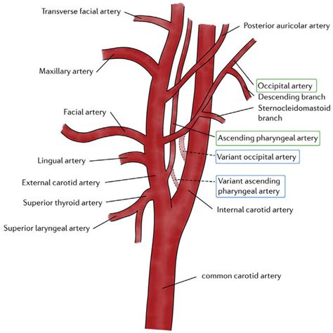 Drawing Showing Anatomic View Of Carotid Bifurcation Internal And