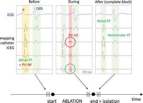 Representative Bipolar Voltage Electrograms Bve The Width Of The Download Scientific Diagram