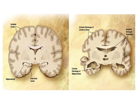 ალცჰაიმერის დაავადების გამომწვევი მიზეზები презентация онлайн