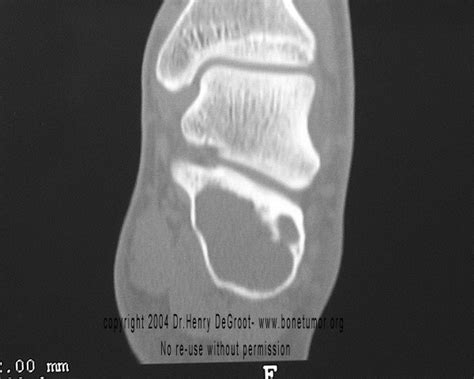 Unicameral Bone Cyst Foot And Ankle