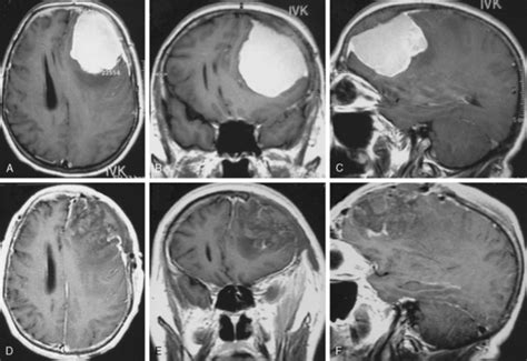 Surgery Of Convexity Meningiomas Neupsy Key
