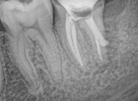 Figure 3 From Non Surgical Management Of Iatrogenic Lateral Root