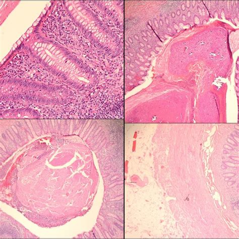 Macroscopically Normallooking Appendix Discovered During Diagnostic Download Scientific