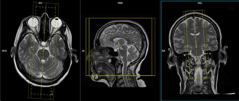 Cerebrospinal Fluid Flow Mri Csf Flow Mri Protocol And Planning