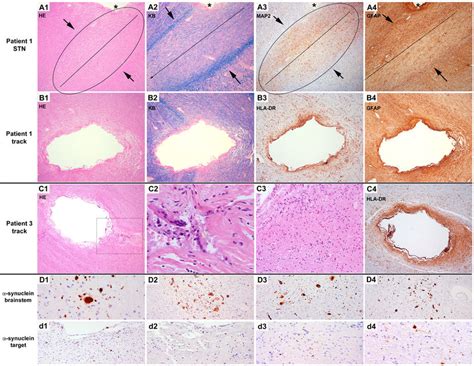 Histological Features At The Subthalamic Nucleus Stn And Track For