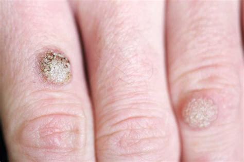 7 Ways Get Rid Of Unwanted Warts Page 17 Of 19 A2z Healthy