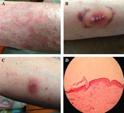 Psoriatic Lesions On Limbs And Histology Of Guttate Psoriatic Patient Download Scientific