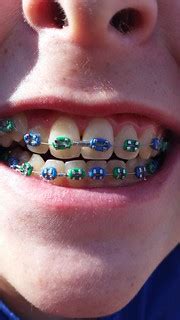 Seahawk Braces Karyn Christner Flickr