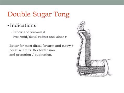 Splints And Tractions Pptx