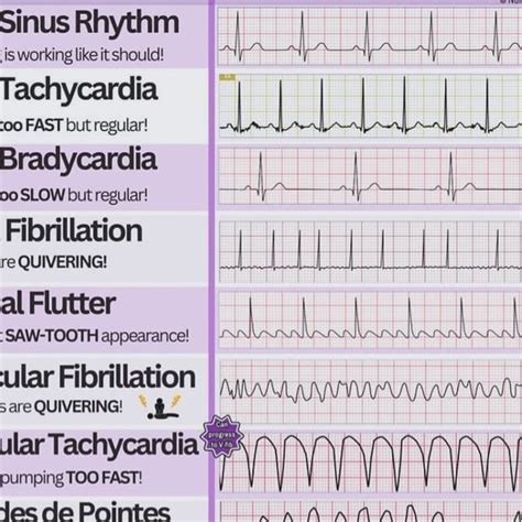 Medical Doctors On Instagram “normal Sinus Rhythm Vs Abnormal Rhythm