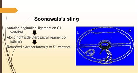Classification And Conservative Surgeries For Prolapse Pptx