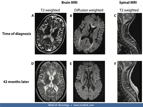 B12 Deficiency Spinal Cord The Hong Kong Practitioner