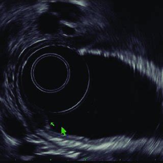 EUS Hypoechoic Gastric Submucosal Tumor Dependent On Superficial Download Scientific Diagram