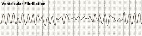 Ventricular Fibrillation