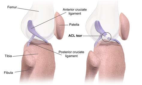 What Is The Difference Between Acl And Meniscus Tear Compare The Difference Between Similar Terms