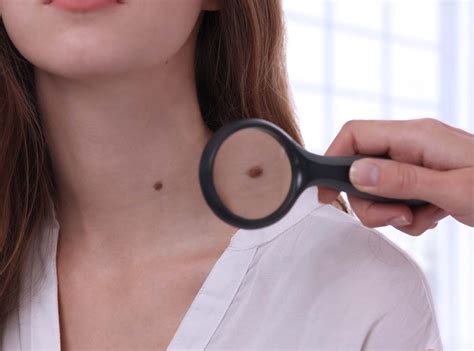 Melanoma What You Need To Know Dermphysicians Of New England