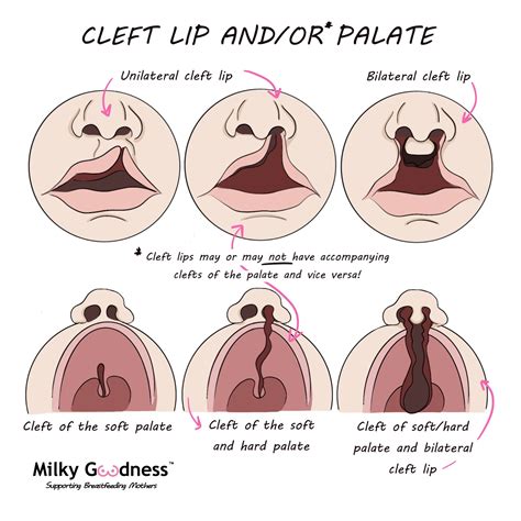 Milky Goodness Cleft Classification During Early Facebook