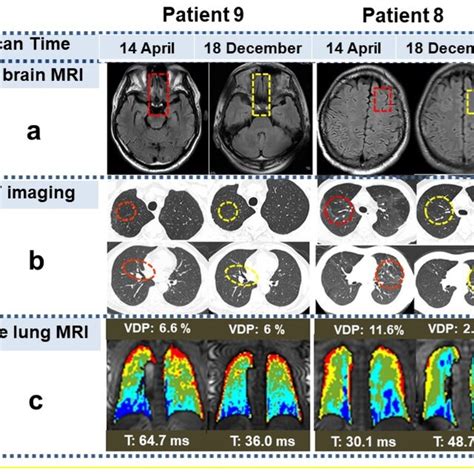 The ¹h Brain Mri A Lung Ct Imaging B And ¹²⁹xe Lung Mri C Of