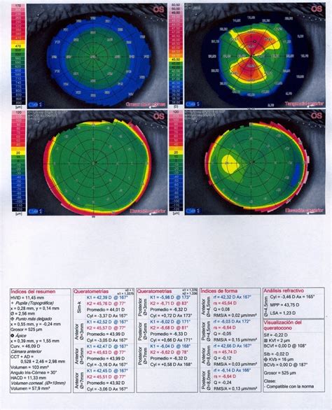 TopografÍa Corneal Manual De Uso Y Disfrute 3 OptoclÍnicos