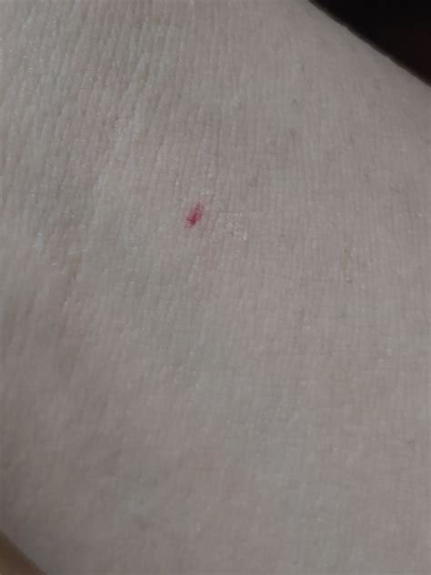 팔에 붉은반점 무엇일까요 지식in