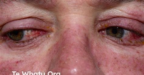 Sjs Ten Ocular Image