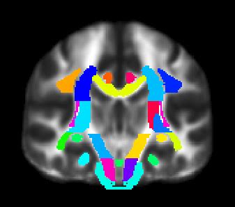 DTI Processing Voxel Based Versus Tract Based Diffusion Imaging Diffusion Imaging
