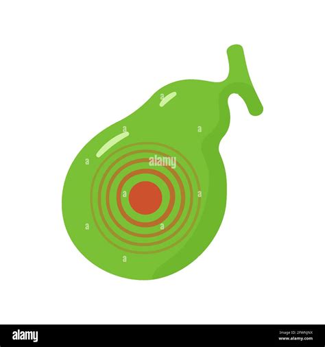 Sick Gallbladder Gallbladder As Symptom Pain Cholecystitis Gallstone
