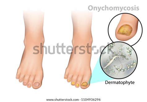 Onychomycosis Tinea Unguium Fungal Nail Infection Stock Vector Royalty