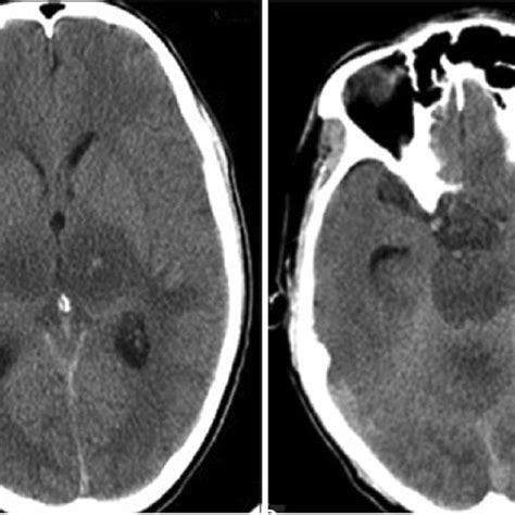 Non Contrast Head Ct Of A 22 Year Old Man With Denv Encephalitis Shows
