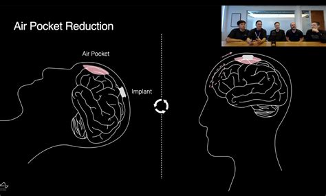 Here S How Neuralink Is Modifying Its Brain Chip For Second Human Patient