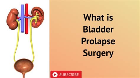 Prolapse Surgery No Mesh At Deloris Colvin Blog