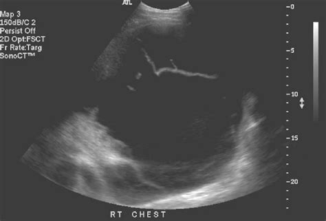 Transthoracic Sonogram Demonstrating A Loculated Pleural Effusion