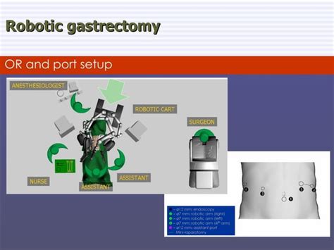 Robotic Gastrectomy For Gastric Cancer A European Experience Ppt