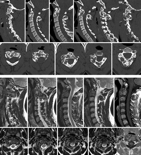 Cervical Ct And Mri Show Lytic And Osteoblastic Bone Lesions That