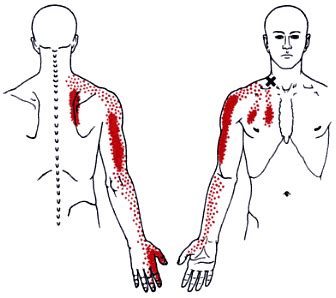 Trigger Points Fuga Massage Therapy Oulu