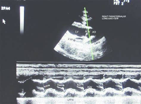 Echocardiogram Showing M Mode Measurement Of Left Atrium And Aorta In