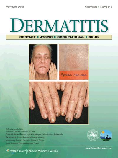 Isocyanates Dermatitis