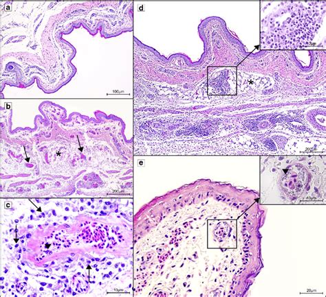 Microscopic Lesions Found In The Skin Of The Birds Photomicrographs Of