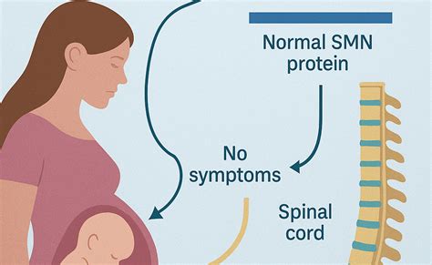 In Utero Gene Rescue Role Of Risdiplam In Treatment Of Fetal Spinal Muscle Atrophy
