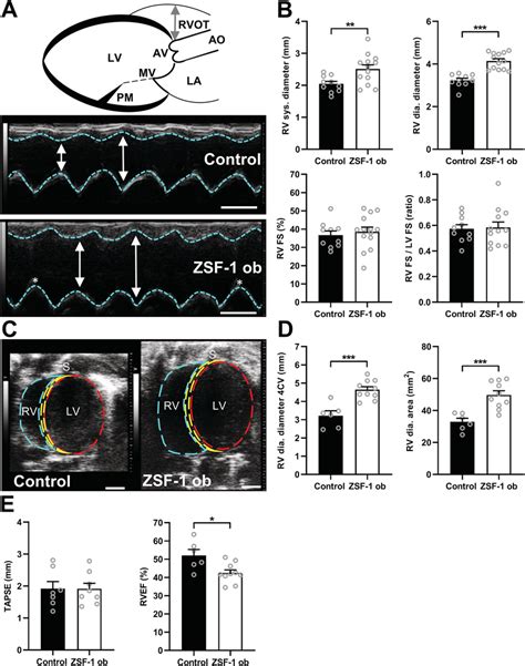 Right Ventricular Dilation In Hfpef A Schematic Of Parasternal