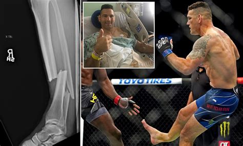 Anderson Silva Broken Leg X Ray