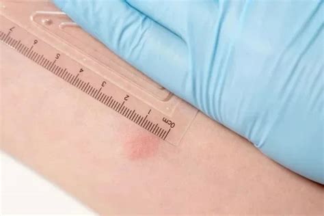 Ppd Prueba De Tuberculina Qué Es Cómo Se Realiza Y Resultados Tua